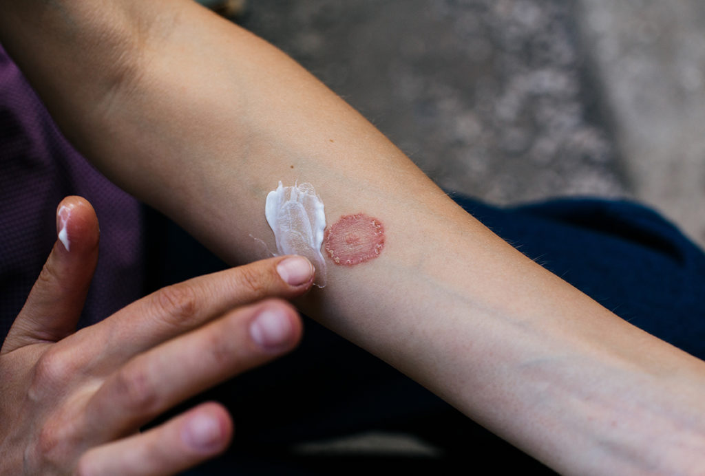 What is Ringworm and How to Identify It? - Speedy Sticks | Mobile Lab ...