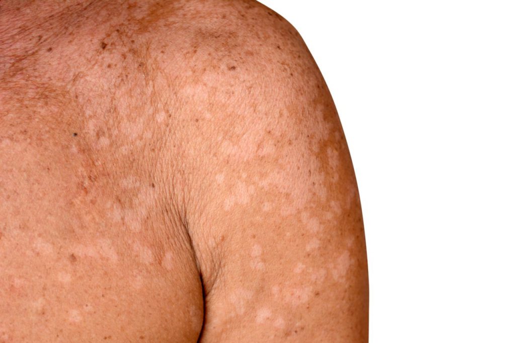 Say Goodbye to Skin Fungus: 10 Natural and Effective Home Remedies ...