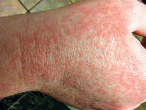 COVID-19 Rash Explained: What You Need to Know - Speedy Sticks | Mobile ...